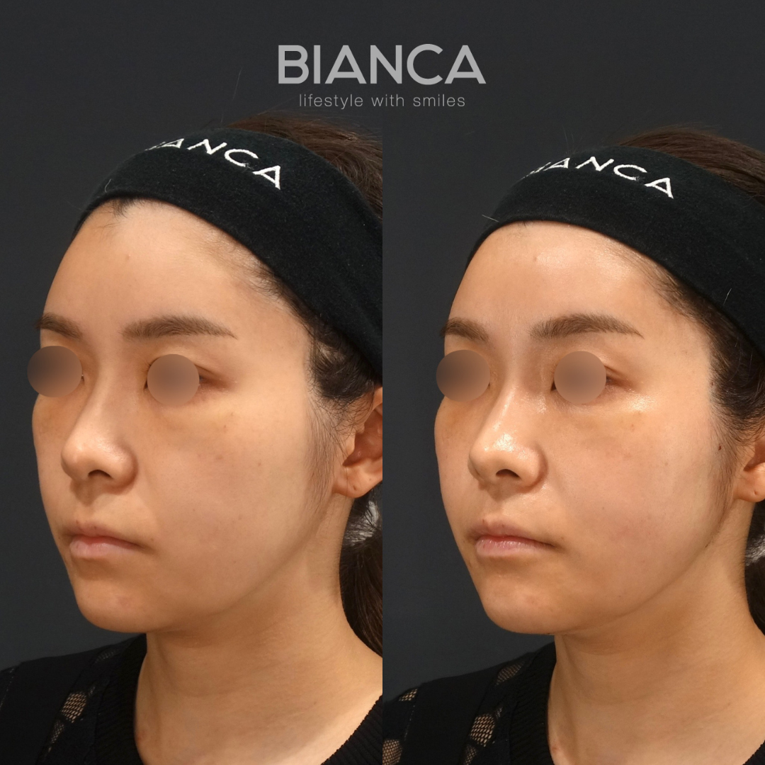 Bianca Lift/Thread Lift | Japan's leading beauty, health and ...